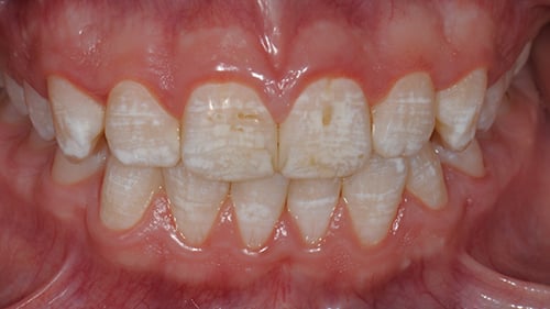 Trattamento estetico della fluorosi dentale: case-report su tecniche ...